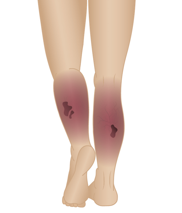 Best Venous Ulcers Treatment in Mumbai at #1 Clinic - The Vein Center ...