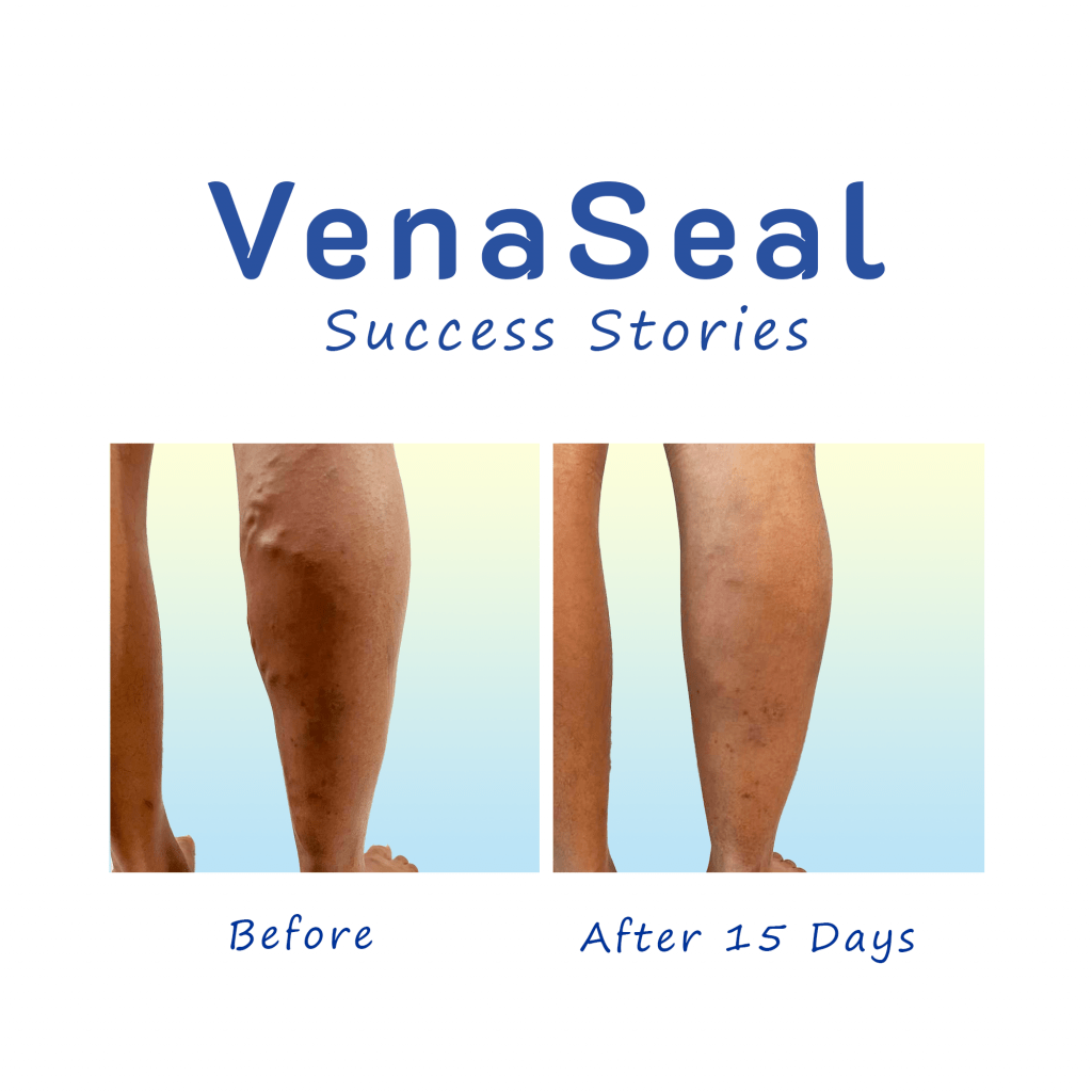 VenaSeal Success Before After Pics 2023 - The Vein Center Mumbai